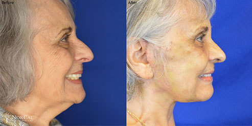 Rhinoplasty Ads - NorCal Plastic Surgery