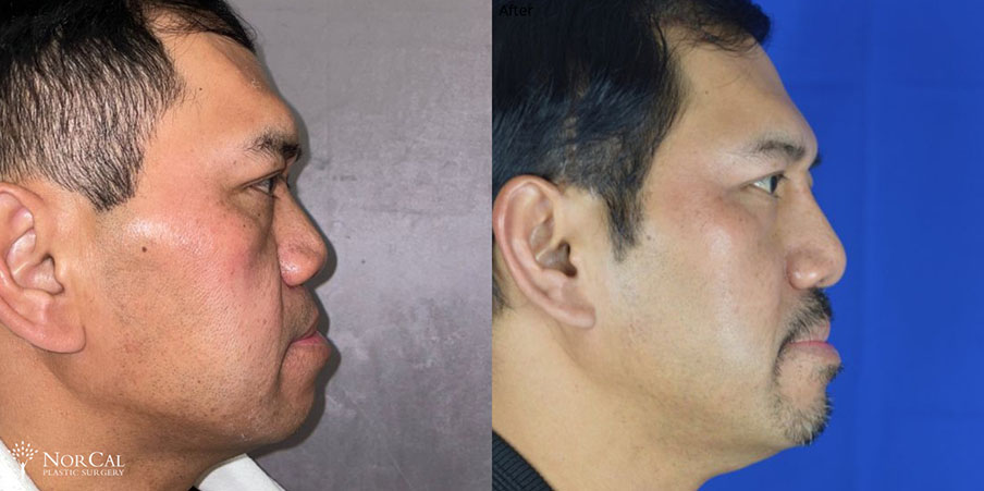 Liquid Rhinoplasty Ads - NorCal Plastic Surgery